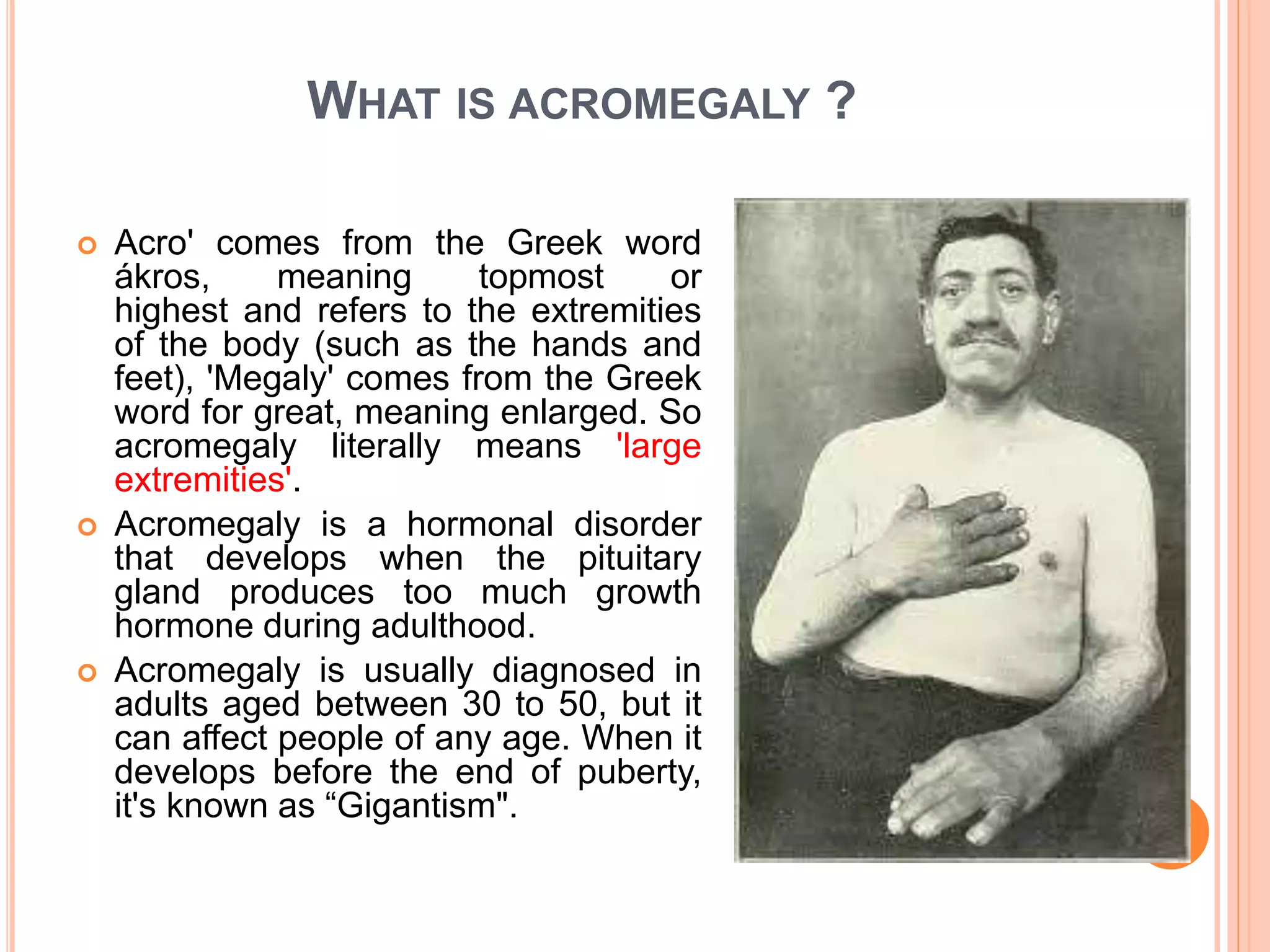 Acromegaly.pptx