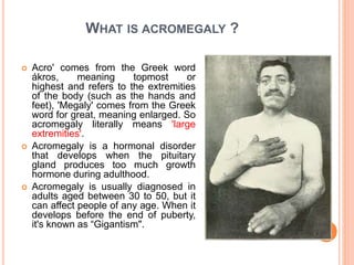 Acromegaly.pptx