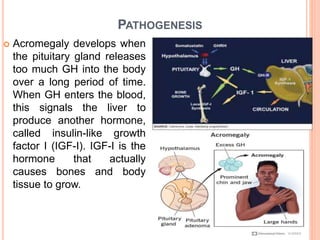 Acromegaly.pptx