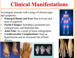Acromegaly.pptx