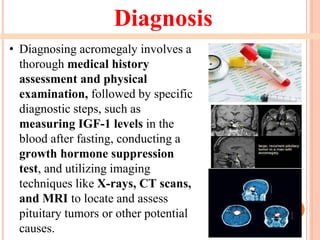 Acromegaly.pptx