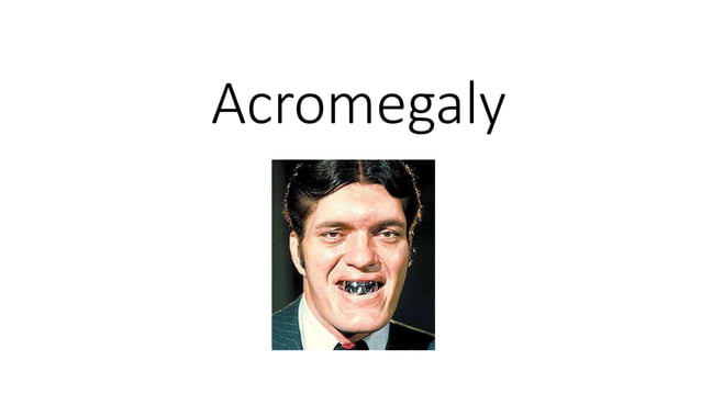 Acromegaly PPT Clinical Practice endocrinology | PPTX | Endocrine and ...