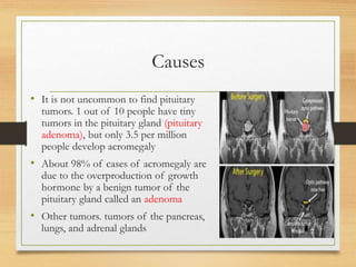 Acromegaly description causes treatment. | PPTX