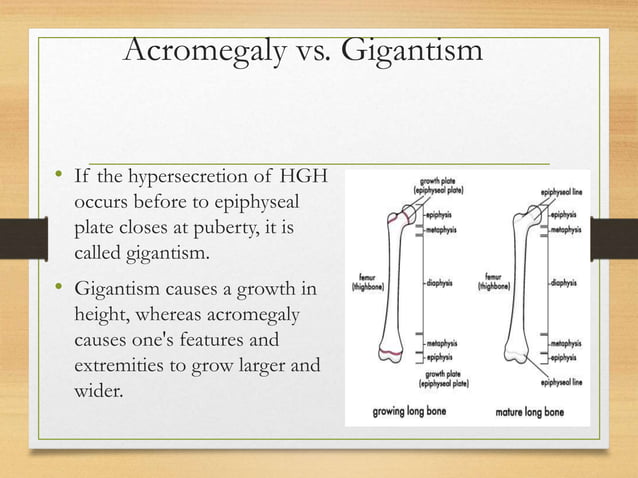 Acromegaly description causes treatment. | PPT