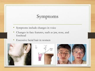 Acromegaly description causes treatment. | PPTX