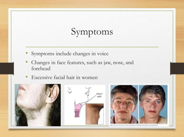 Acromegaly description causes treatment. | PPT