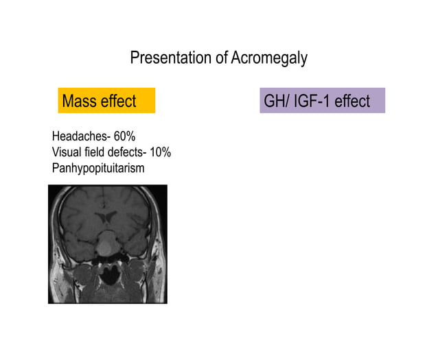 slide about Acromegaly amongs children.pdf