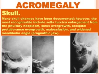 Acromegaly 1 | PPTX