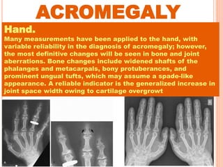 Acromegaly 1 | PPTX