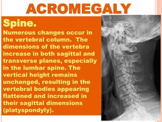 Acromegaly 1 | PPTX