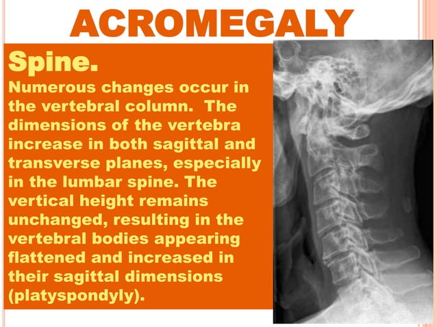 Acromegaly 1 | PPT | Free Download