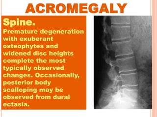Acromegaly 1 | PPTX