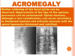 Acromegaly 1 | PPTX