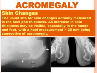 Acromegaly 1 | PPT | Free Download