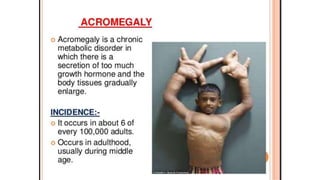 acromegaly and Cushing's syndrome .pptx