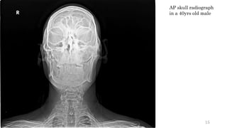 Acromegaly.pptx