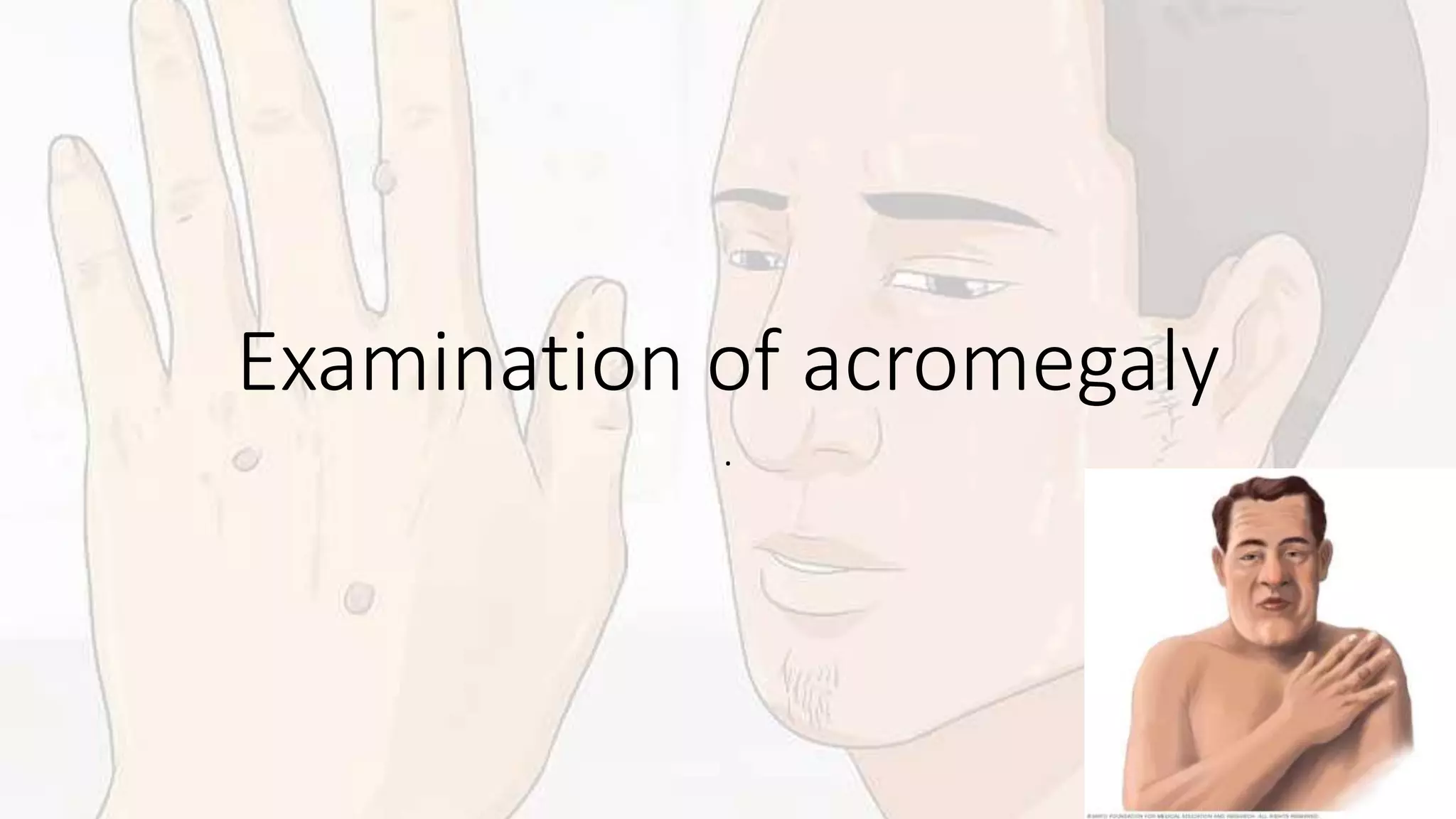 Acromegaly examination (I M GIANT) | PPTX