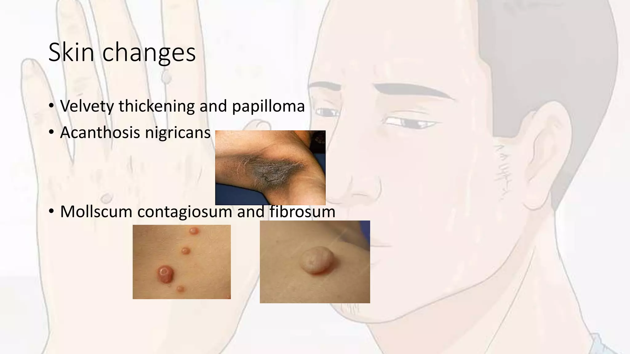 Acromegaly examination (I M GIANT) | PPTX