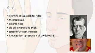 Acromegaly examination (I M GIANT) | PPTX