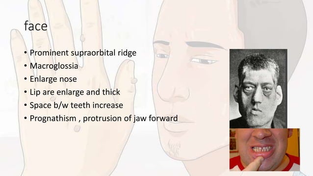 Acromegaly examination (I M GIANT) | PPT