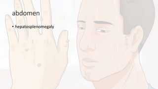 Acromegaly examination (I M GIANT) | PPTX