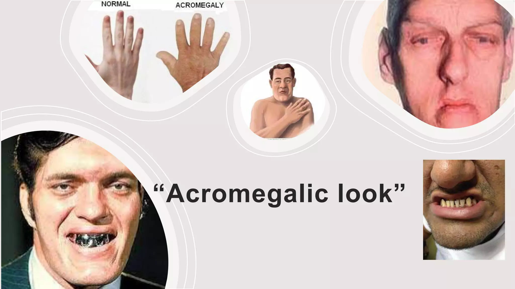 Acromegaly FINAL.pptx