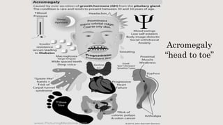 Acromegaly FINAL.pptx