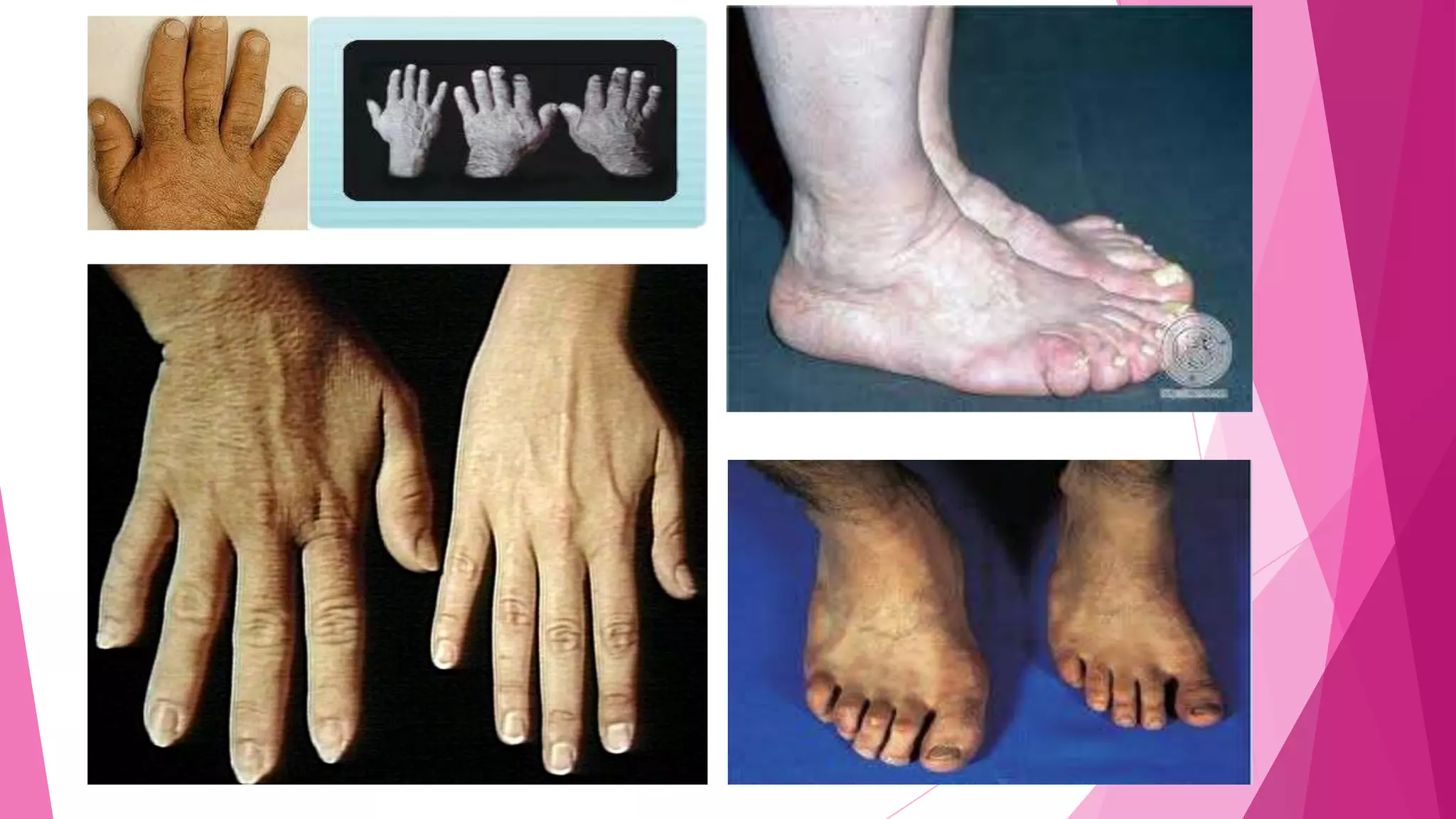 Acromegaly & gigantism | PPTX