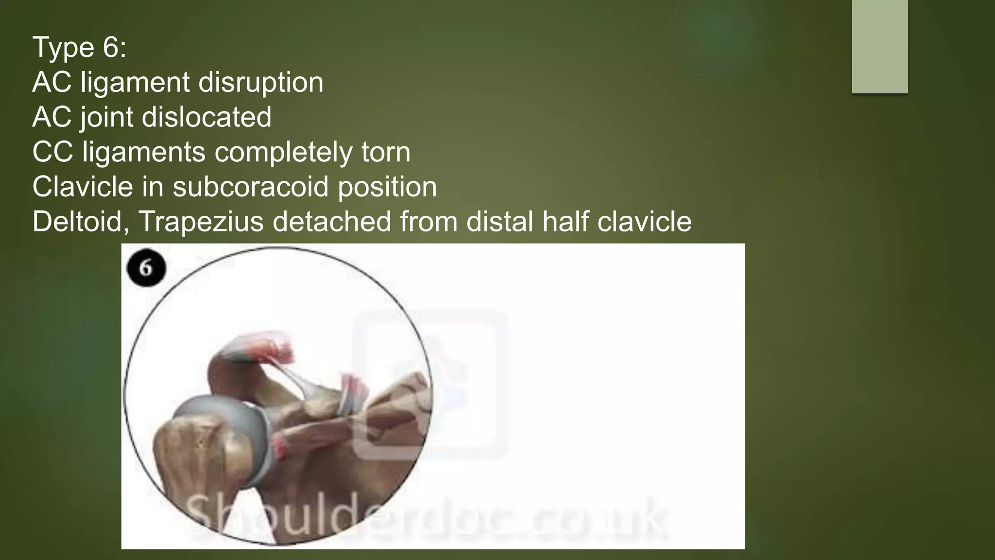 Acromio clavicular joint injury | PPTX