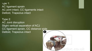 Acromio clavicular joint injury | PPTX