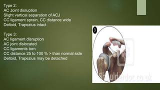 Acromio clavicular joint injury | PPTX
