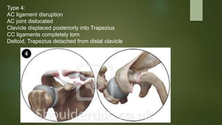 Acromio clavicular joint injury | PPTX