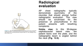 Acromioclavicular.pptx