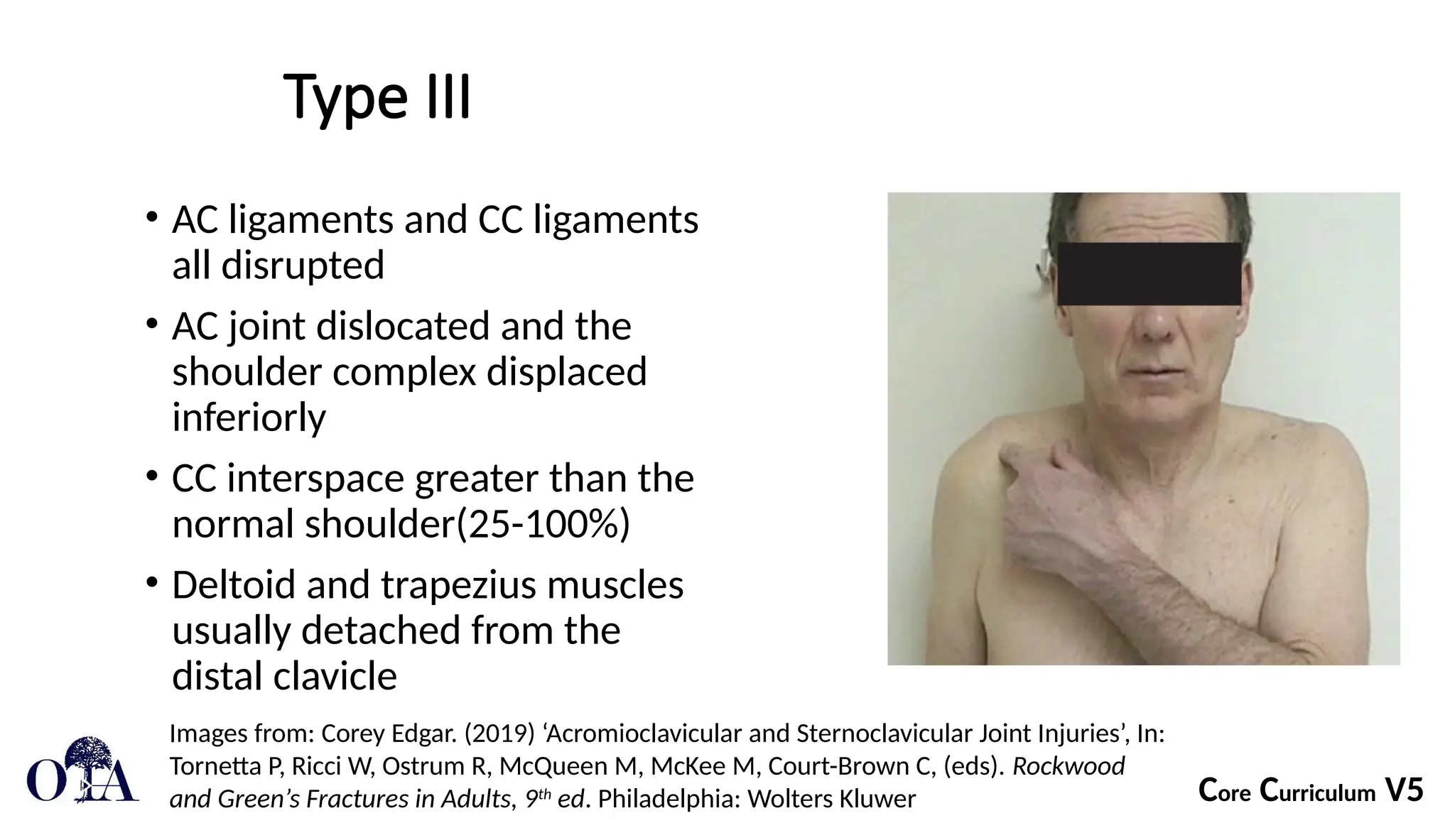 Acromioclavicular and Sternoclavicular Injuries.pptx