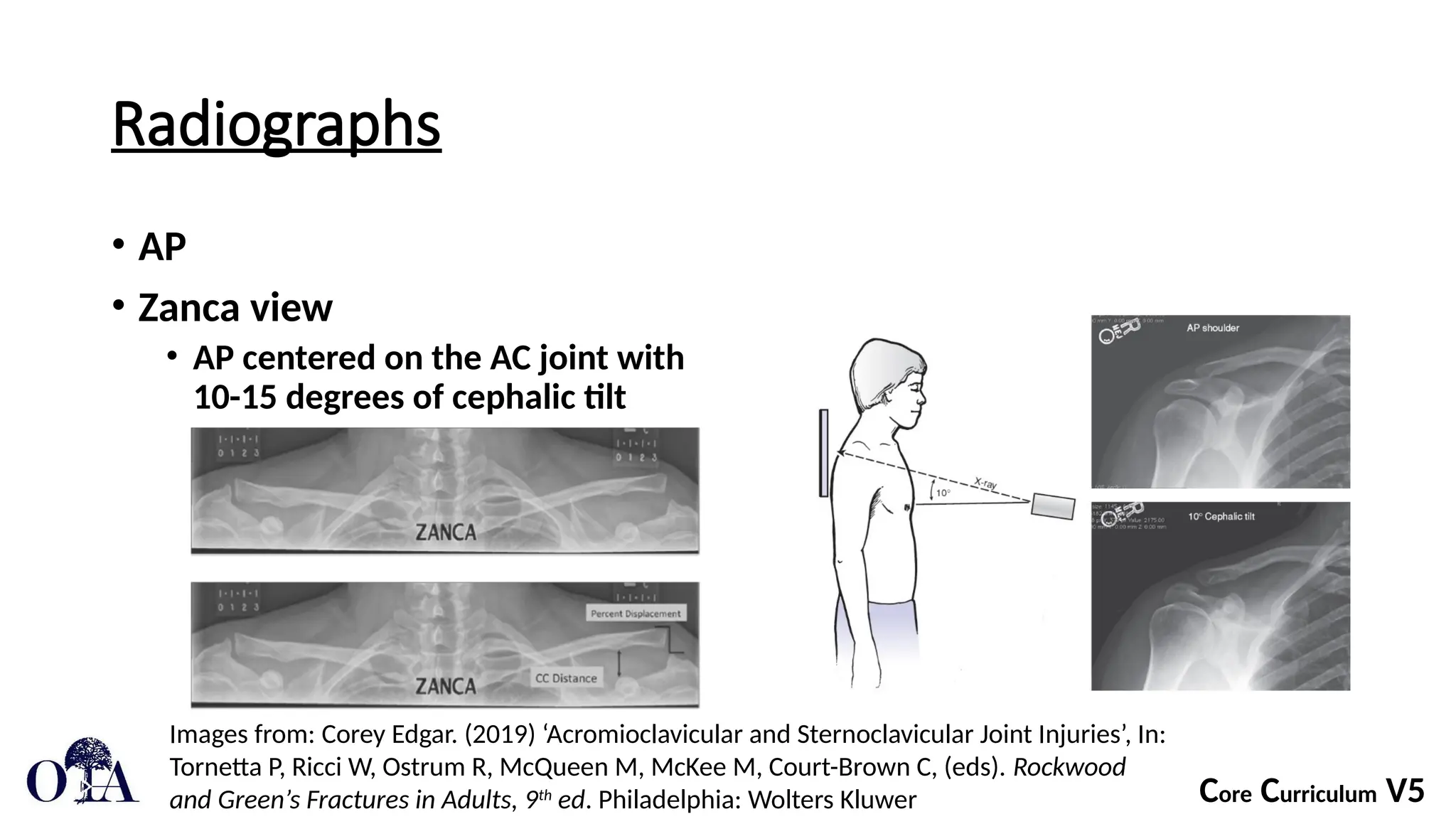 Acromioclavicular and Sternoclavicular Injuries.pptx