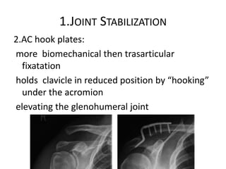 Acromioclavicular and sternoclaviculr injuries | PPTX