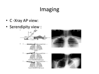 Acromioclavicular and sternoclaviculr injuries | PPTX