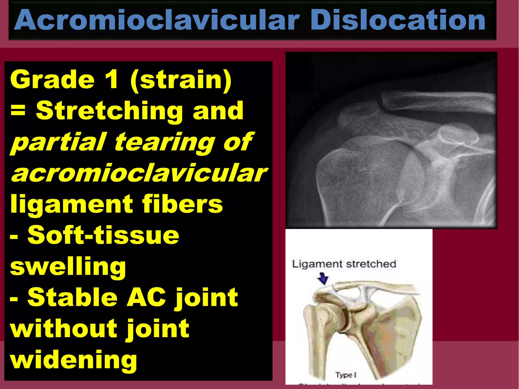 Acromioclavicular dislocation | PPTX