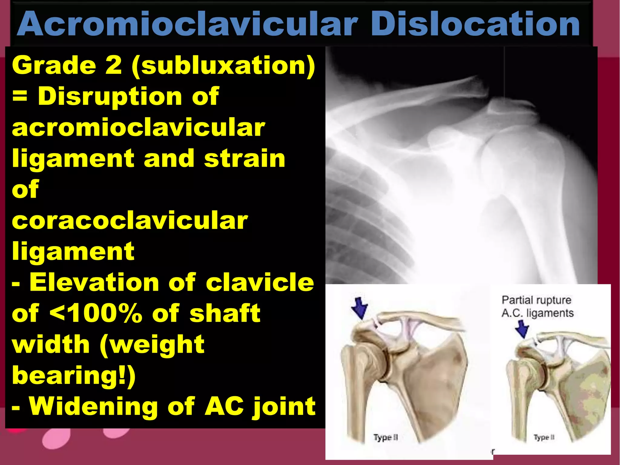 Acromioclavicular dislocation | PPTX