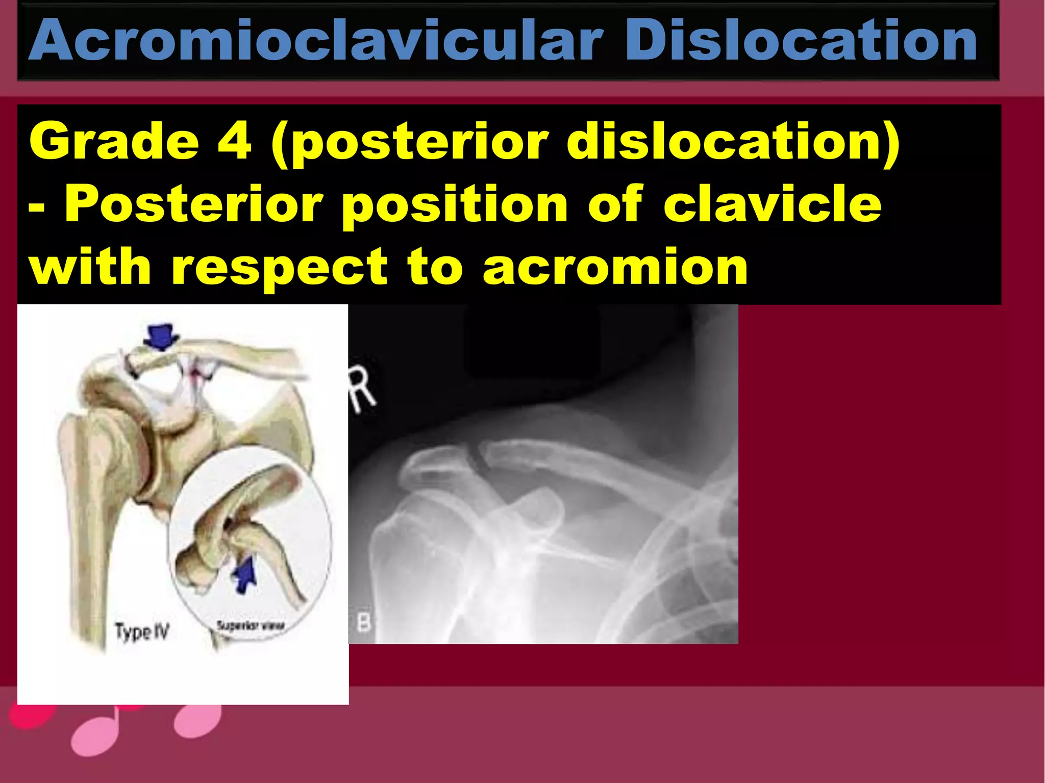 Acromioclavicular dislocation | PPTX