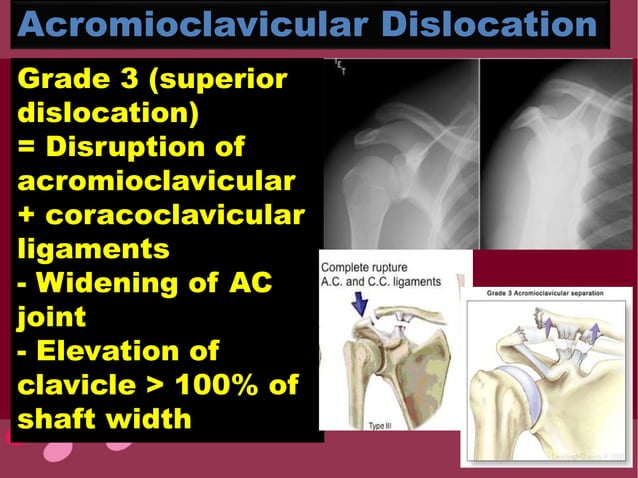 Acromioclavicular dislocation | PPTX