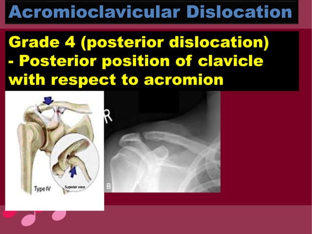 Acromioclavicular dislocation | PPTX