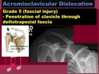 Acromioclavicular dislocation | PPTX