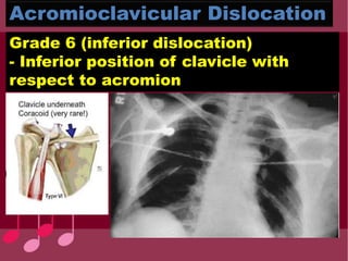 Acromioclavicular dislocation | PPTX