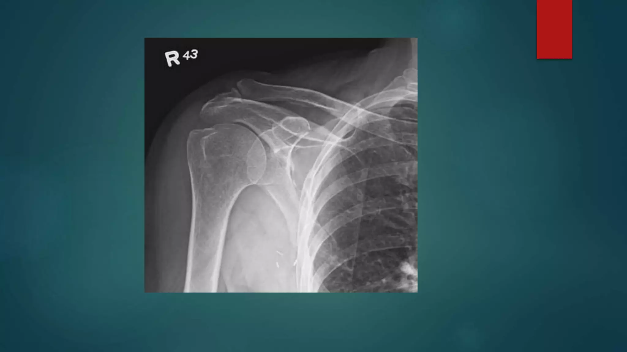 Acromioclavicular joint arthritis | PPTX | Death, Injury, or Military ...