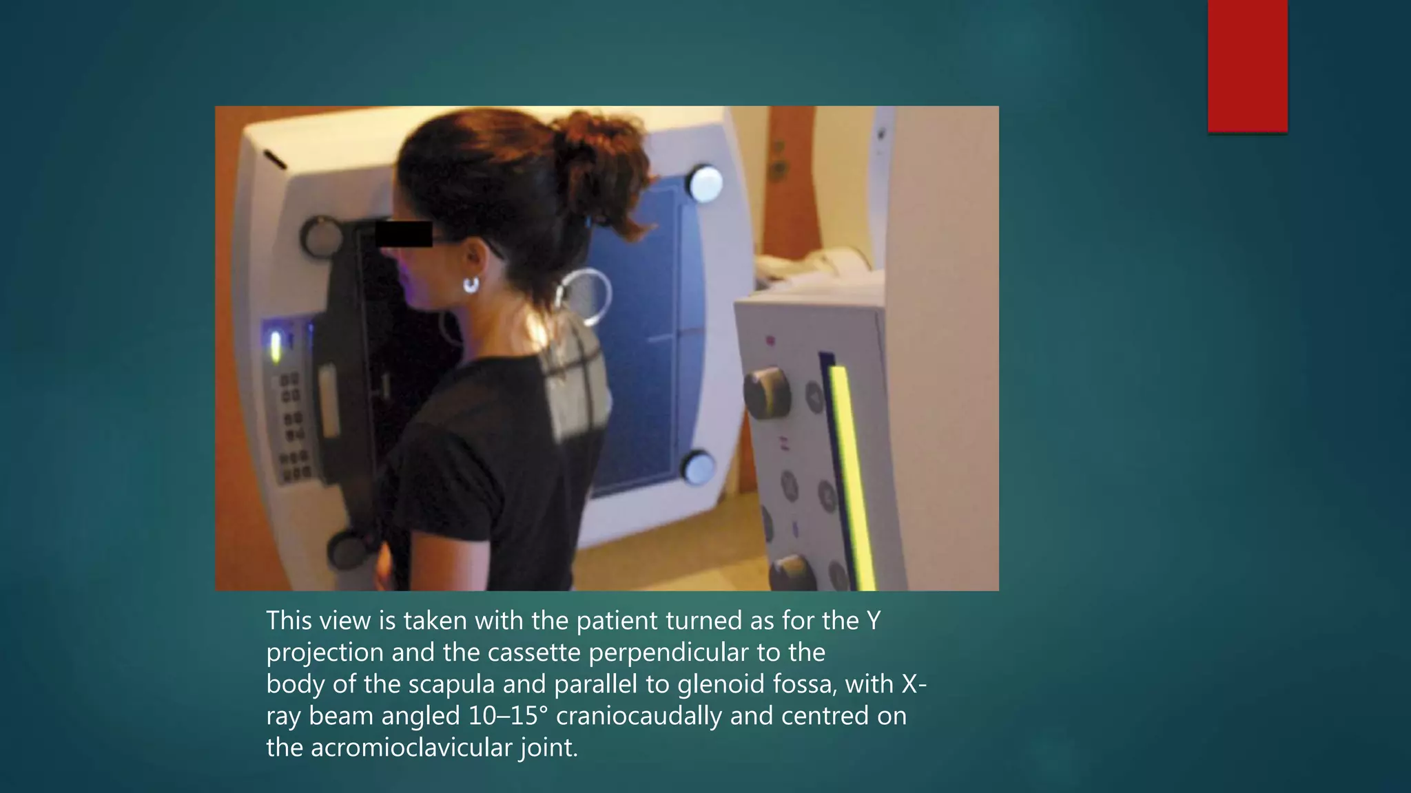 Acromioclavicular joint arthritis | PPTX