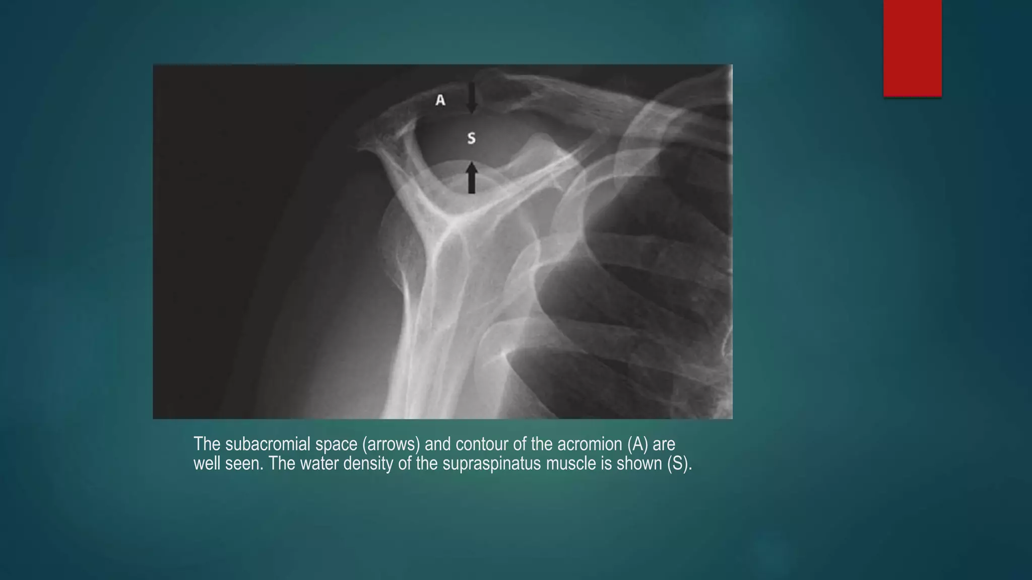 Acromioclavicular joint arthritis | PPTX | Death, Injury, or Military ...