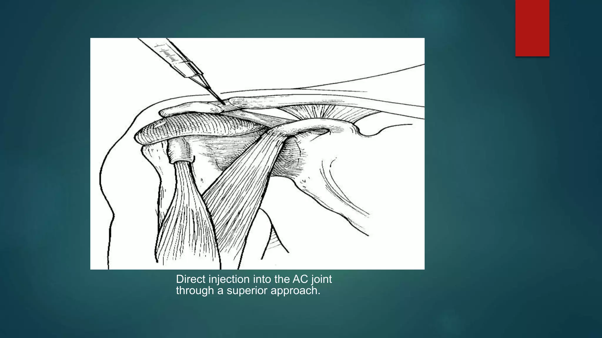 Acromioclavicular joint arthritis | PPTX | Death, Injury, or Military ...