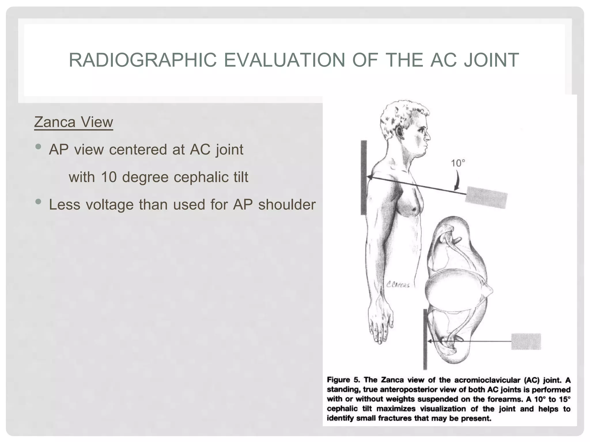 Acromioclavicular joint injury | PPTX