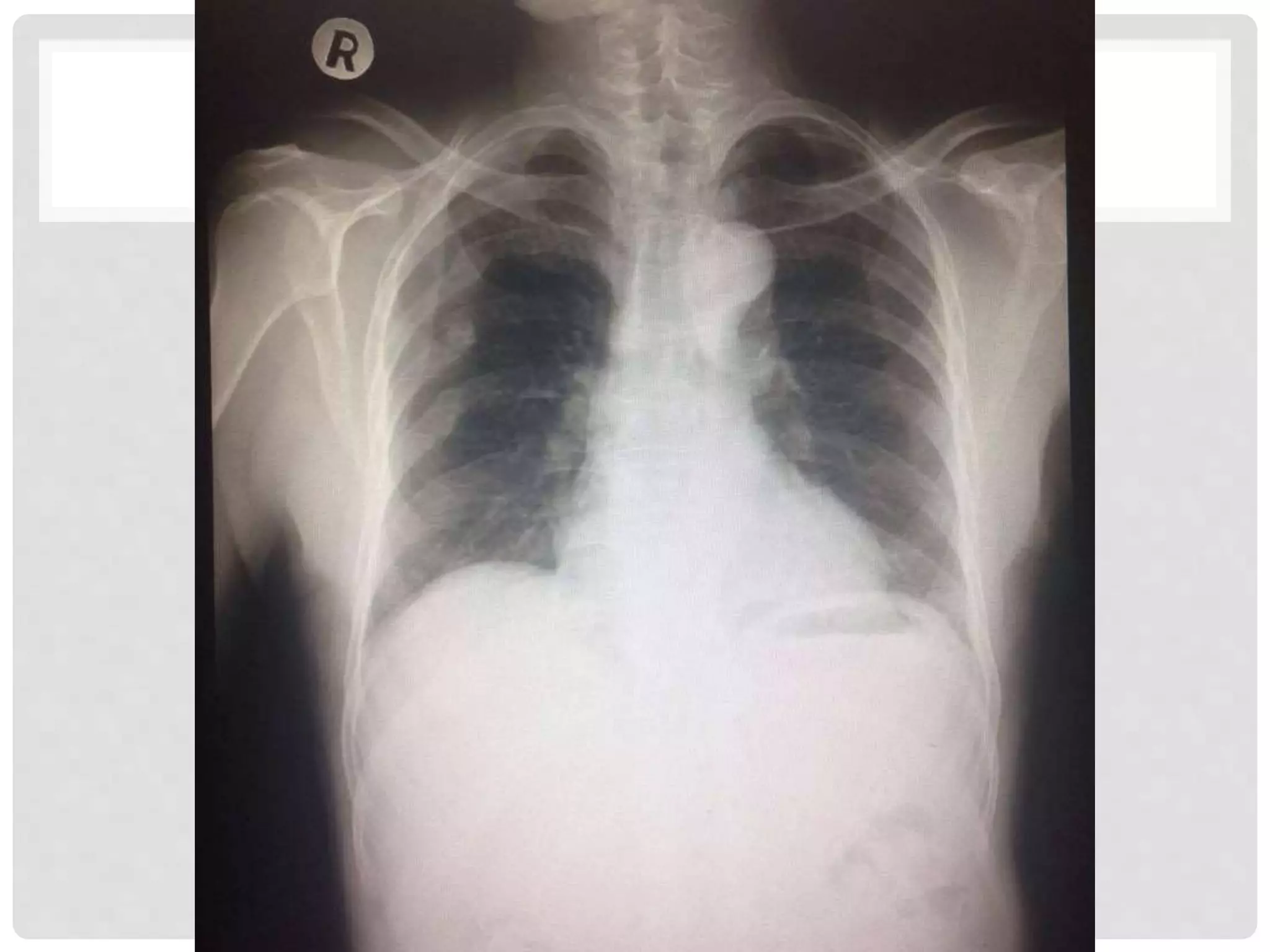 Acromioclavicular joint injury | PPTX